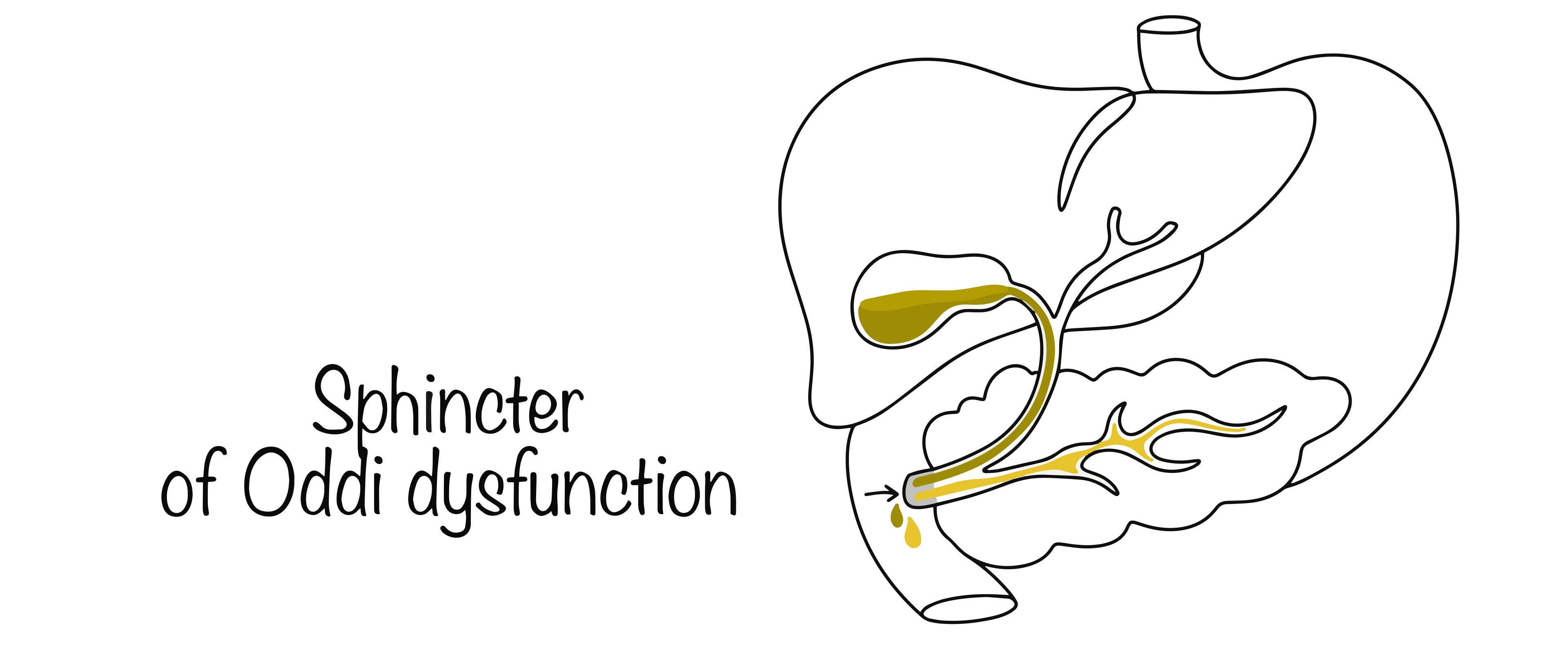 Endoscopic sphincterotomy for sphincter of Oddi dysfunction
