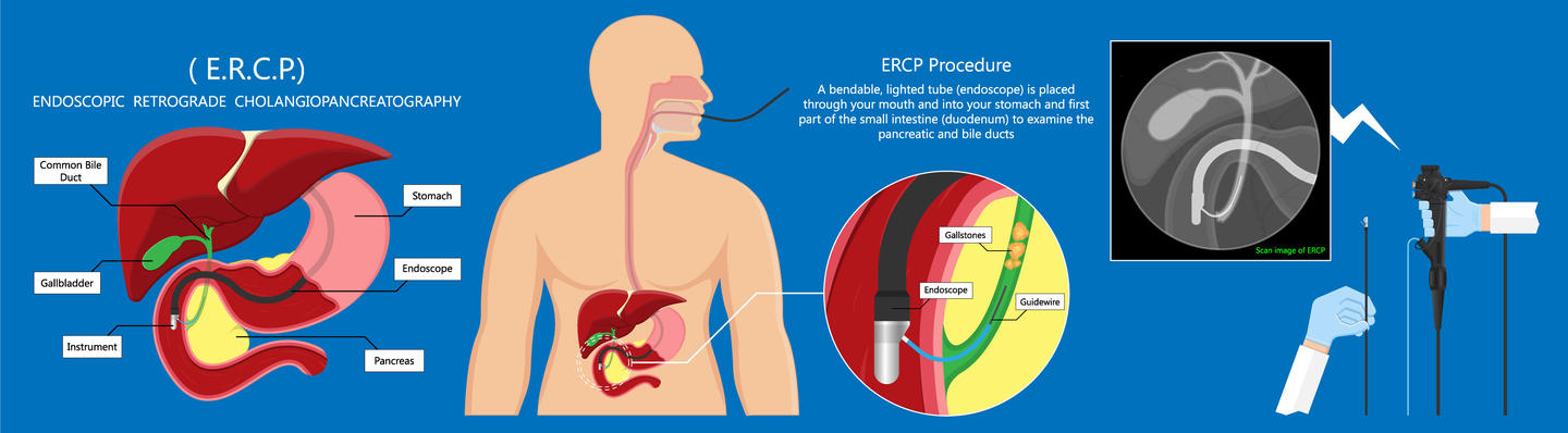 Endoscopic sphincterotomy and risk of post-ERCP pancreatitis after ...