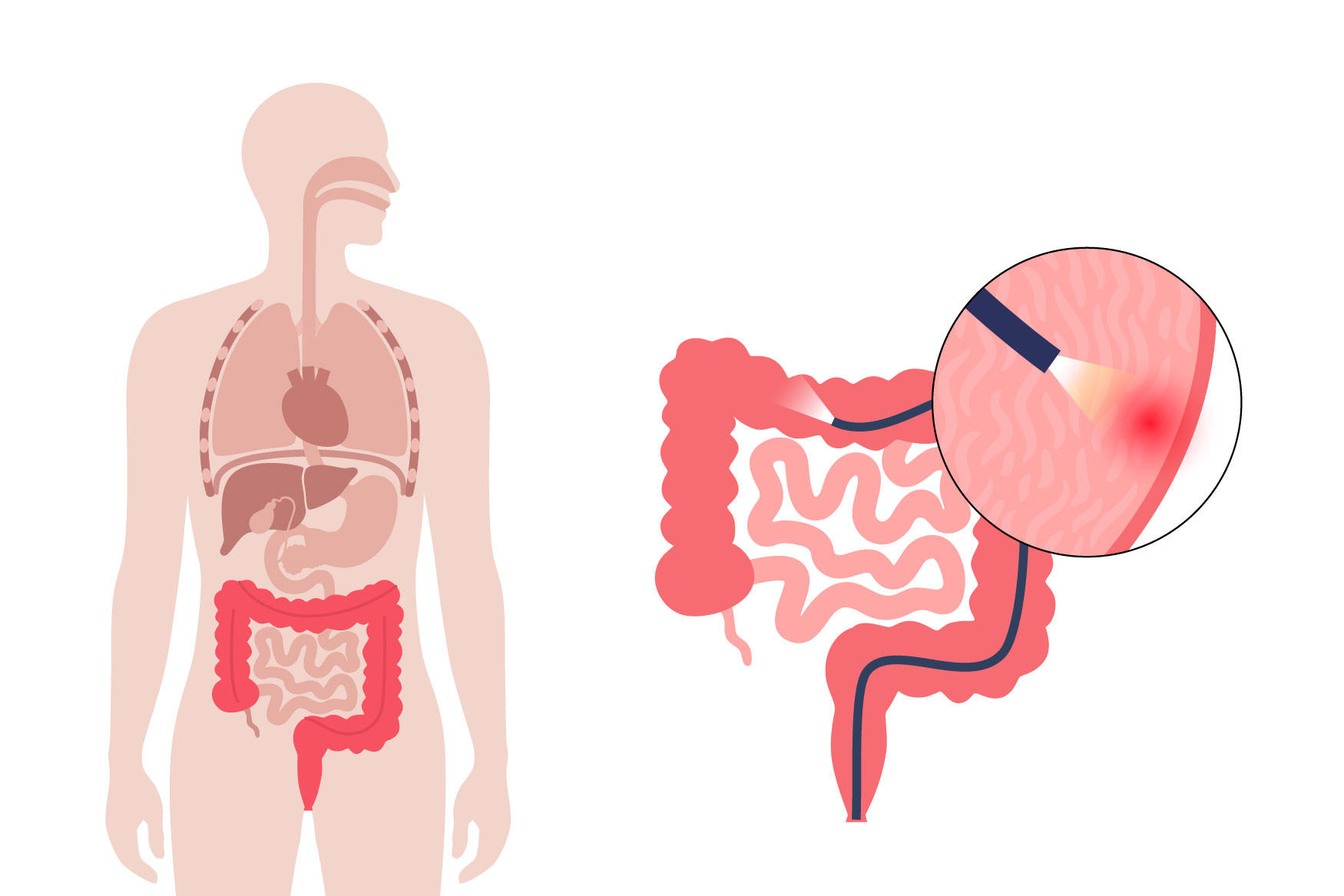 Endoscopic colorectal cancer screening in inflammatory bowel disease ...