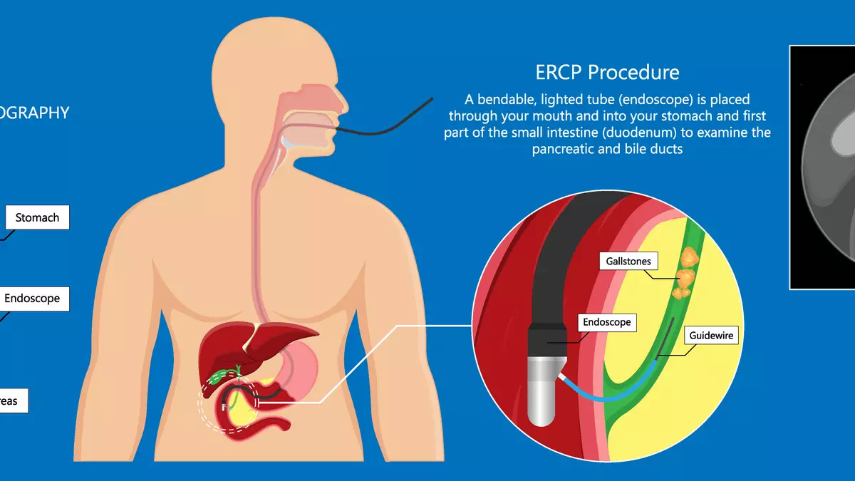 Endoscopic sphincterotomy and risk of post-ERCP pancreatitis after ...